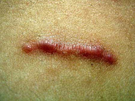 Cicatriz Hipertrófica (Fotos, Dicas, Tratamentos, Remédios)