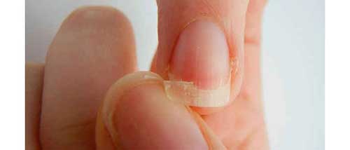 Unhas Quebradiças: Causas e Como Tratar (Tratamento)