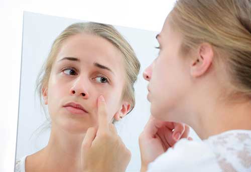 GUIA: Tipos e Graus de Acne/Espinha + Fotos!